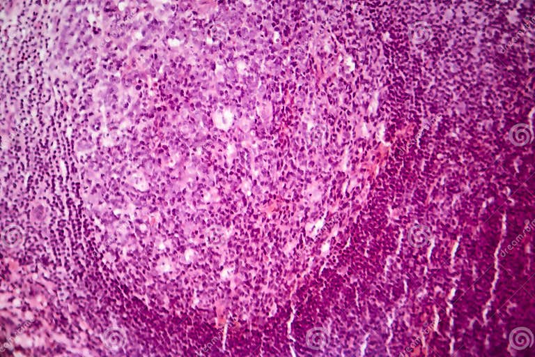 Acute Simple Appendicitis, Light Micrograph Stock Illustration ...