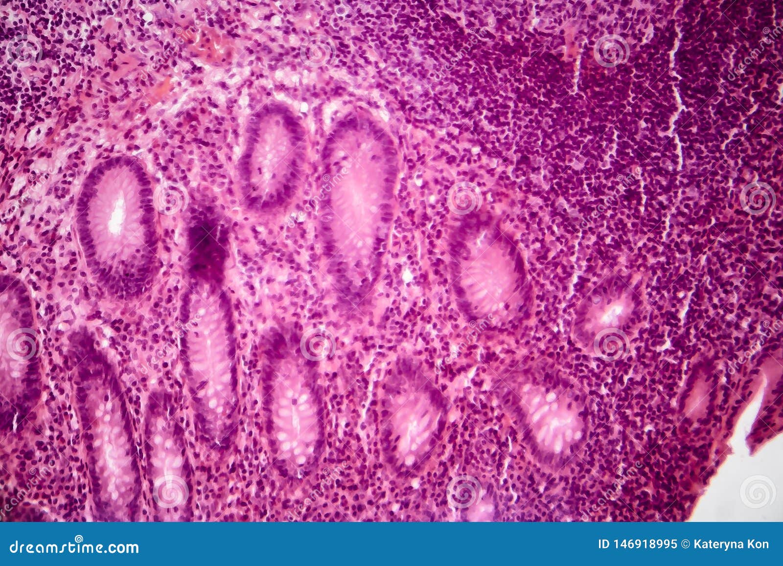 Acute Simple Appendicitis, Light Micrograph Royalty-Free Stock ...