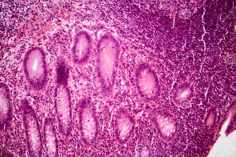 Acute Simple Appendicitis, Light Micrograph Stock Illustration ...