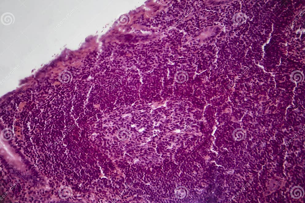 Acute Simple Appendicitis, Light Micrograph Stock Illustration ...