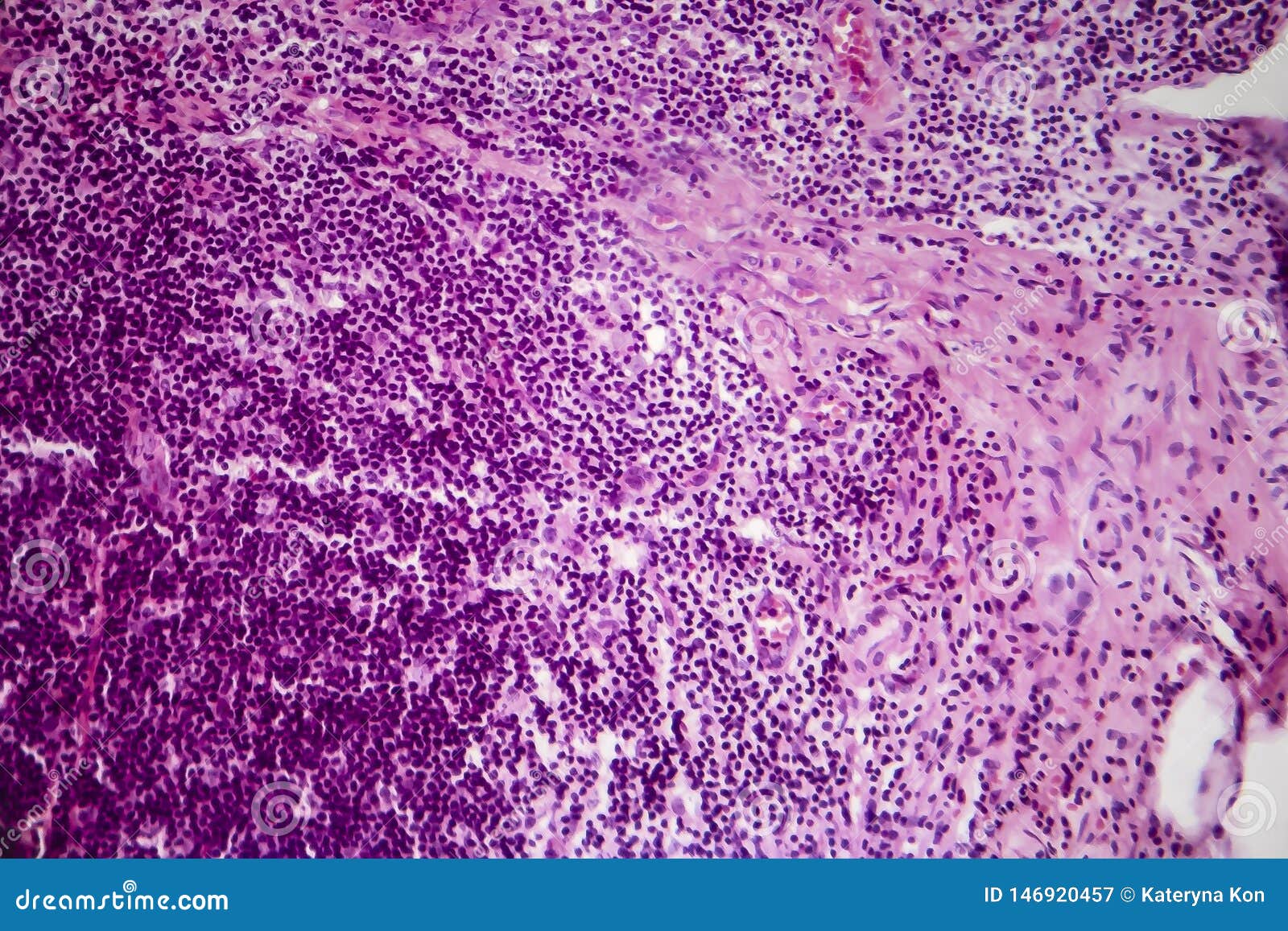Acute Simple Appendicitis, Light Micrograph Stock Illustration ...