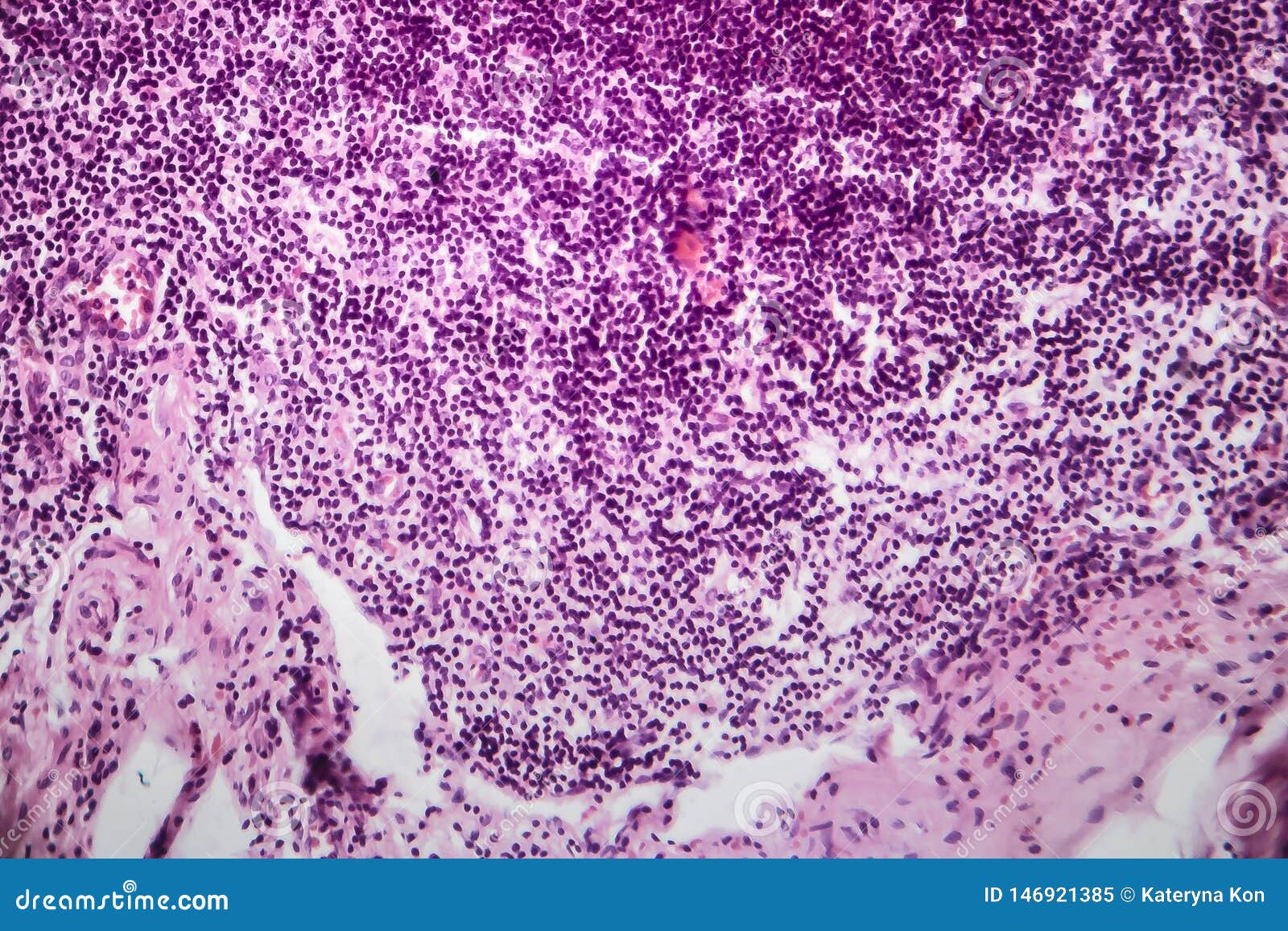 Acute Simple Appendicitis, Light Micrograph Stock Illustration ...