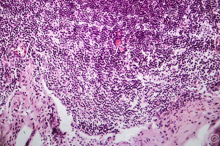 Acute Simple Appendicitis, Light Micrograph Stock Illustration ...