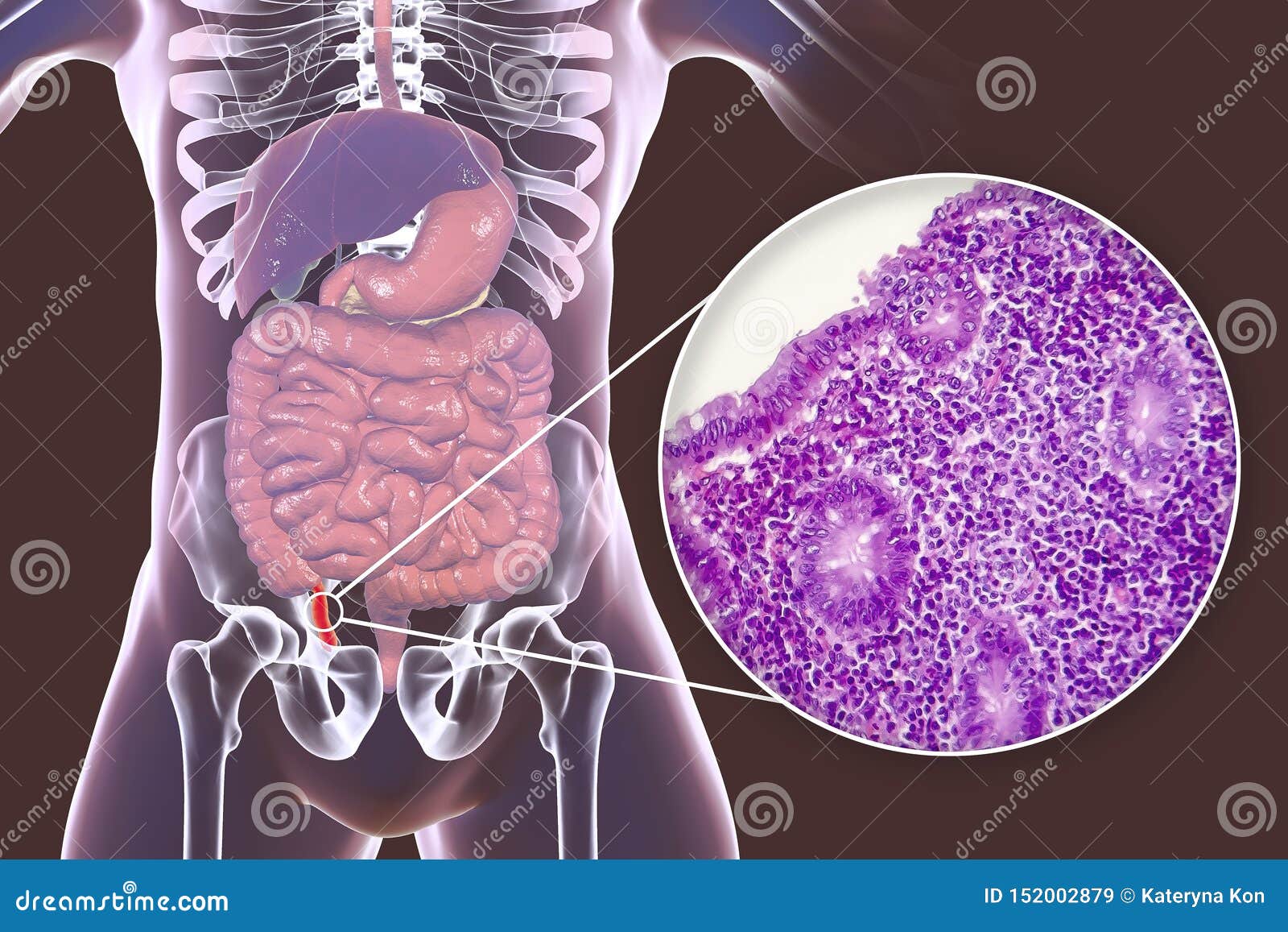 Acute Suppurative Appendicitis, Illustration and Light Micrograph Stock ...