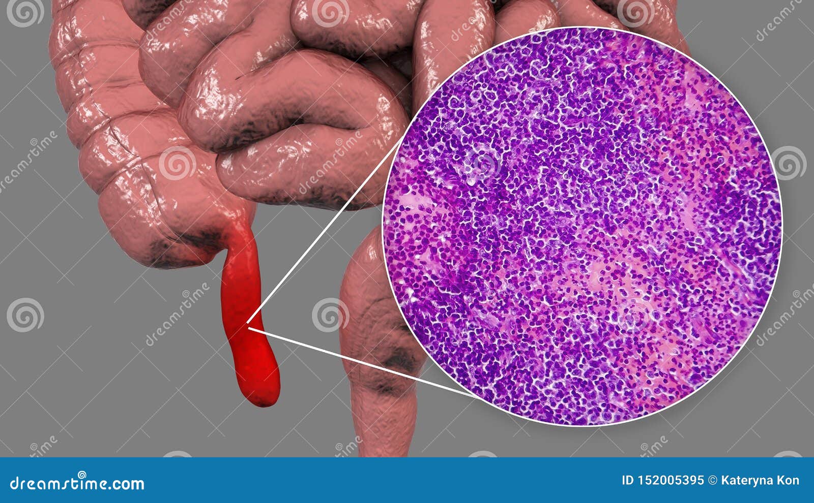 Acute Suppurative Appendicitis Illustration And Light Micrograph Stock