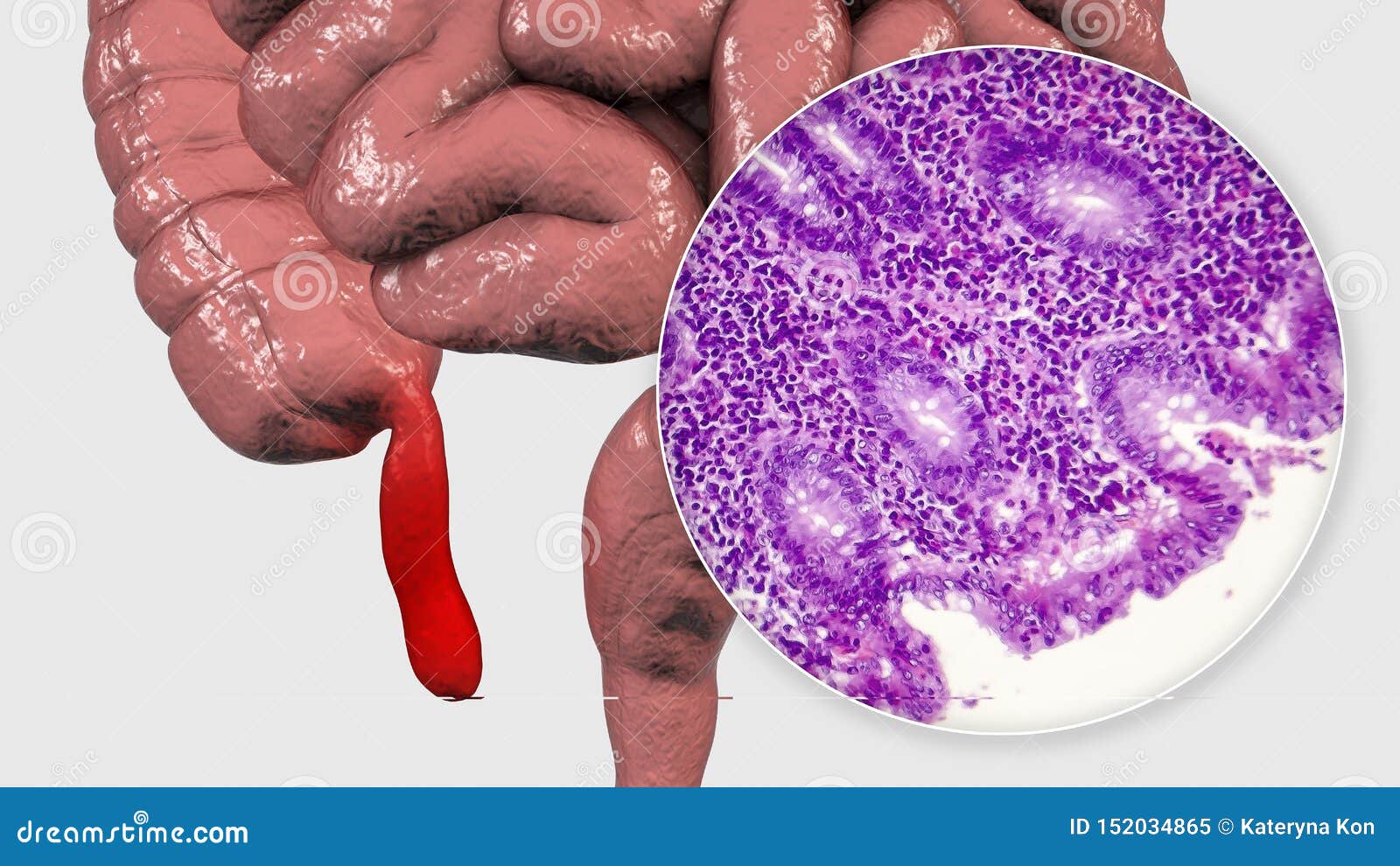 Acute Suppurative Appendicitis Illustration And Light Micrograph Stock