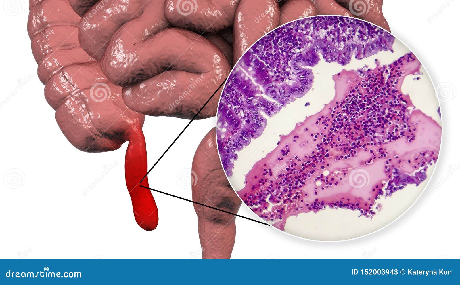 Acute Suppurative Appendicitis Illustration And Light Micrograph Stock