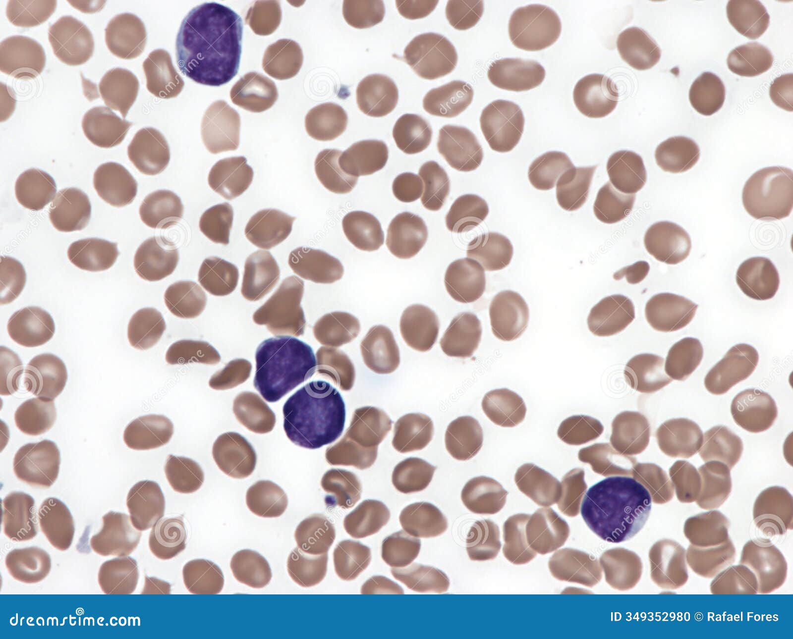 Acute Undifferentiated Leukemia in Bone Marrow. Stock Photo - Image of ...