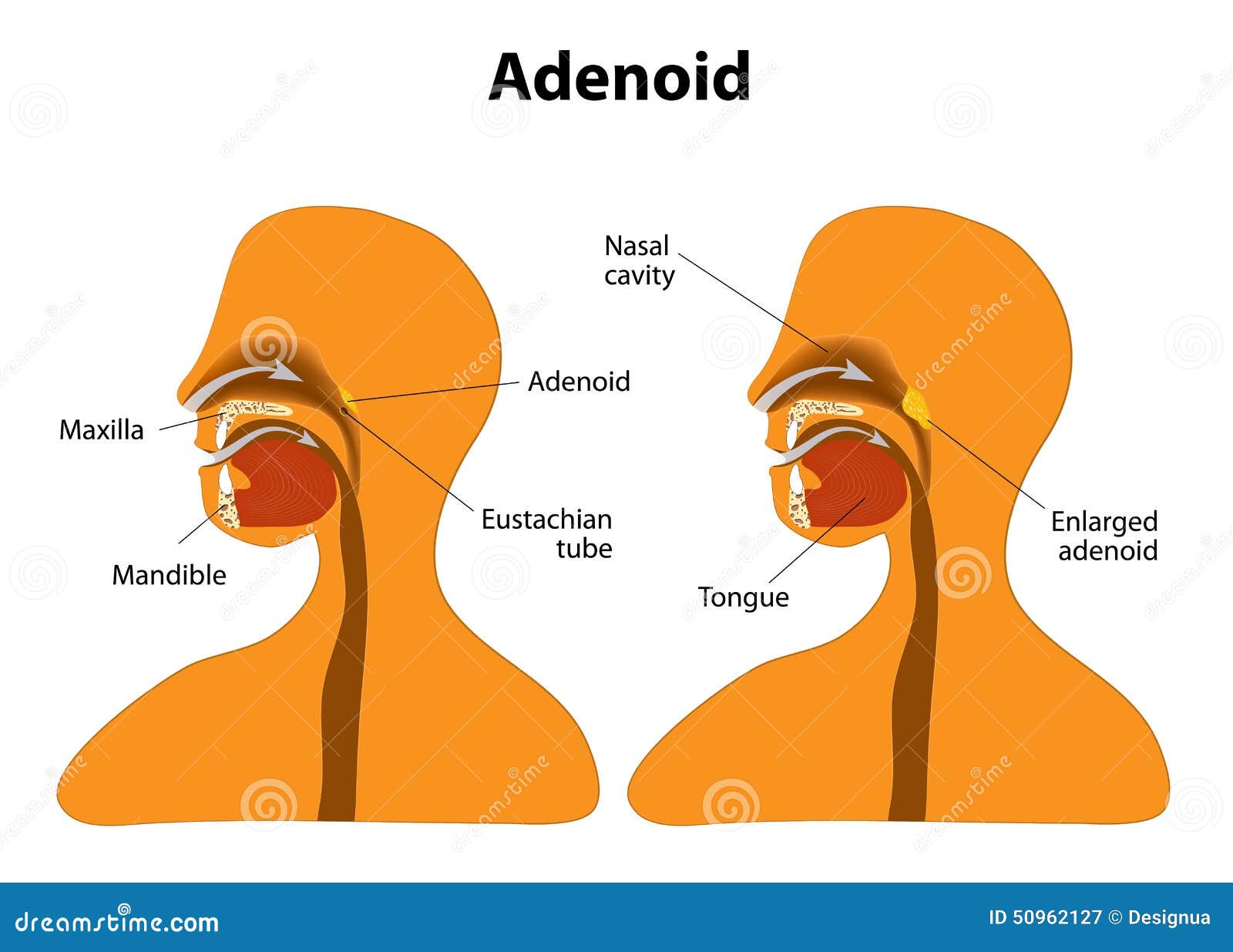 Adenóide Adenoide Normal E Ampliado Ilustração do Vetor - Imagem: 50962127