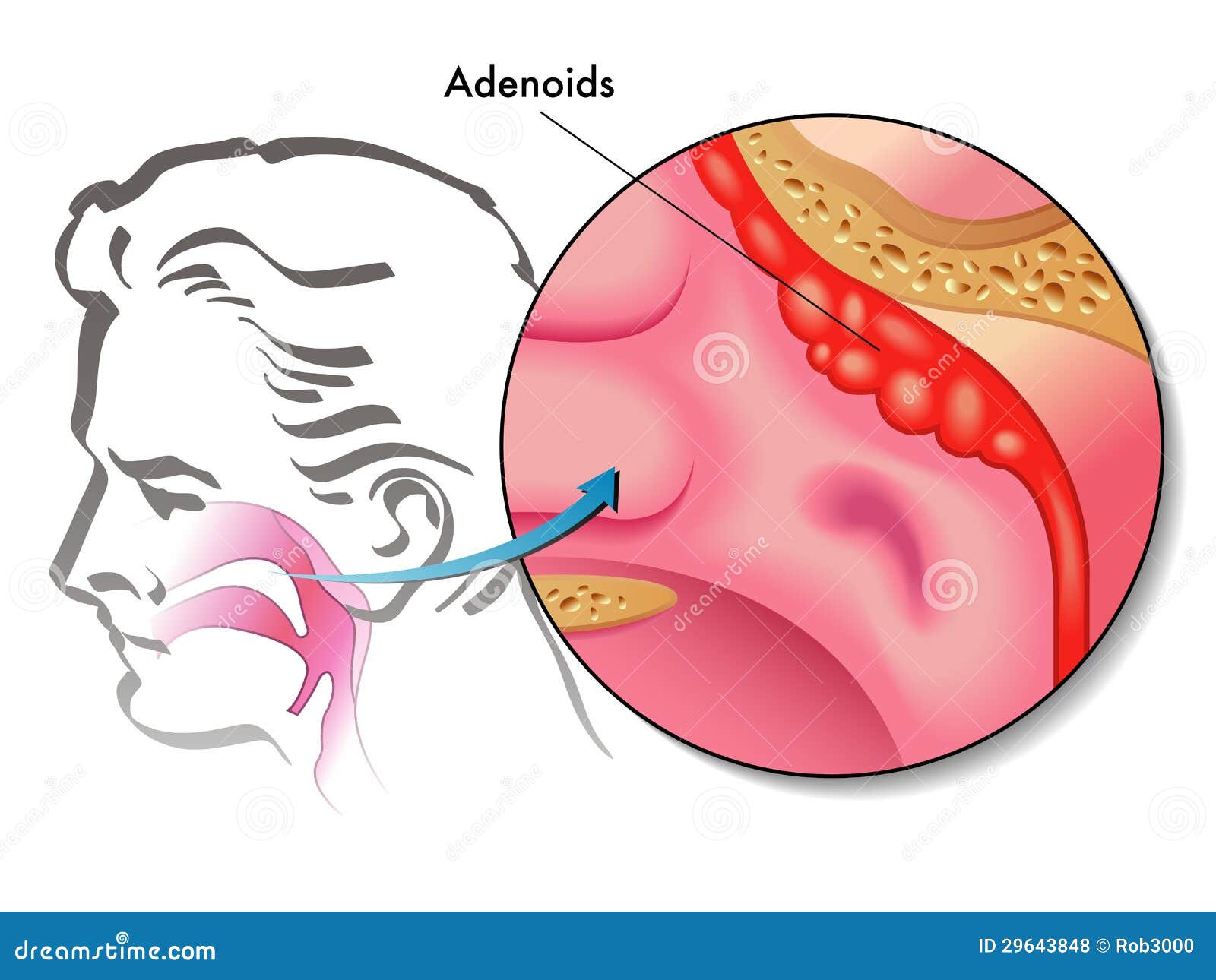 Adenoidi illustrazione vettoriale. Illustrazione di adenoidi - 29643848