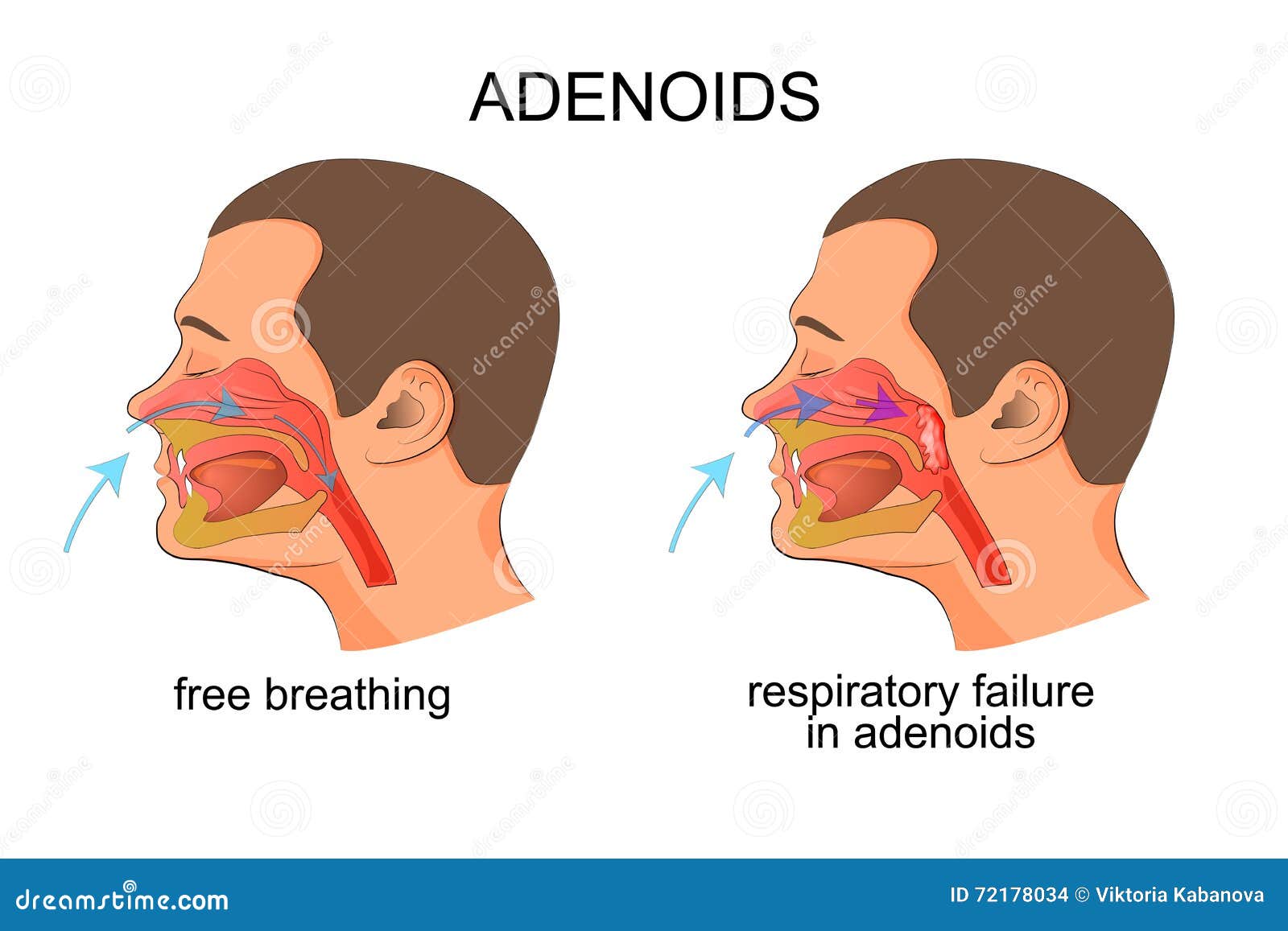 Enlarged Adenoid Glands Cartoon Vector | CartoonDealer.com #46045793 Enlarged Adenoid Glands Cartoon Vector | CartoonDealer.com #46045793