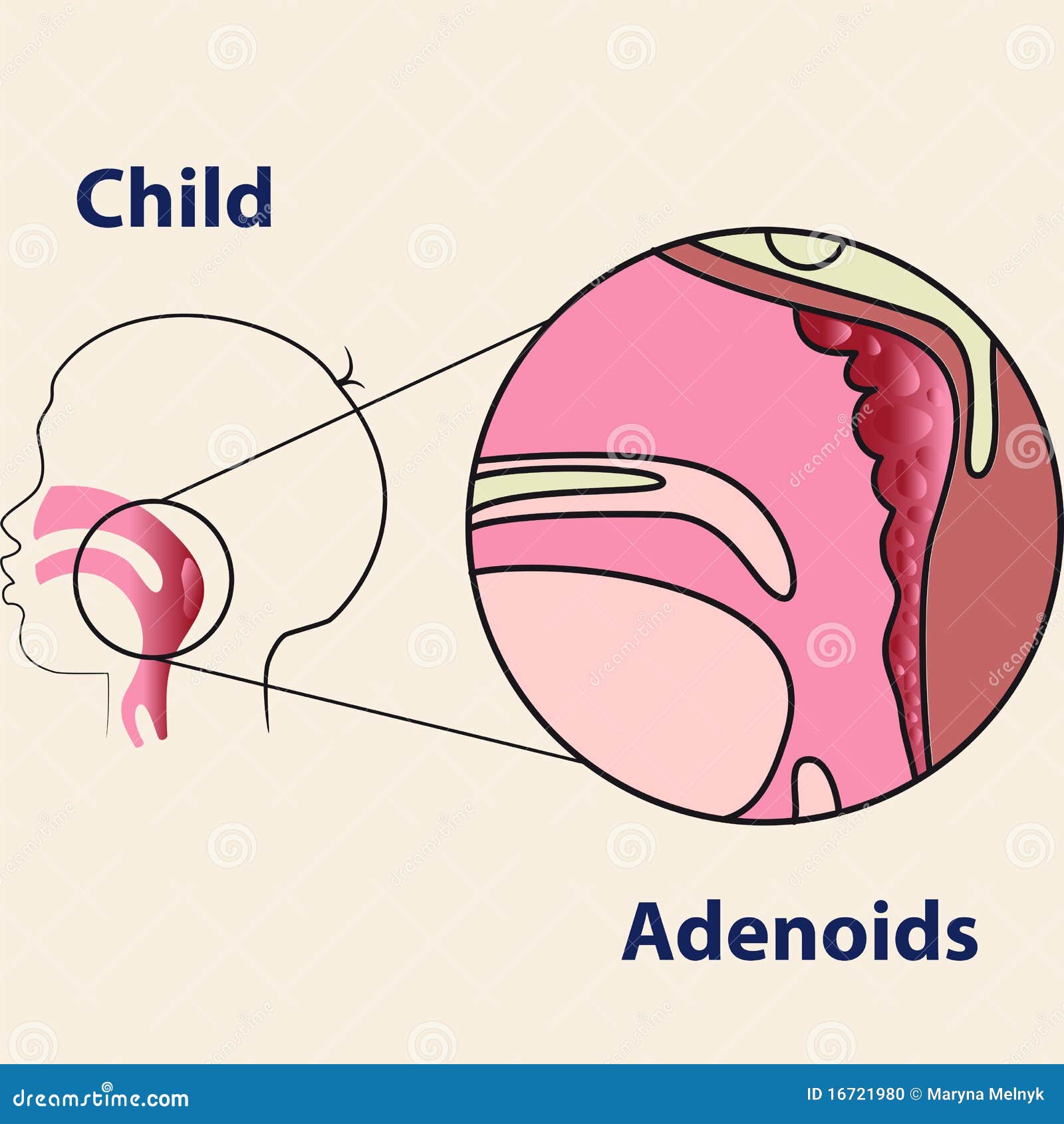 Adenoids stock vector. Illustration of pharynx, angina - 16721980