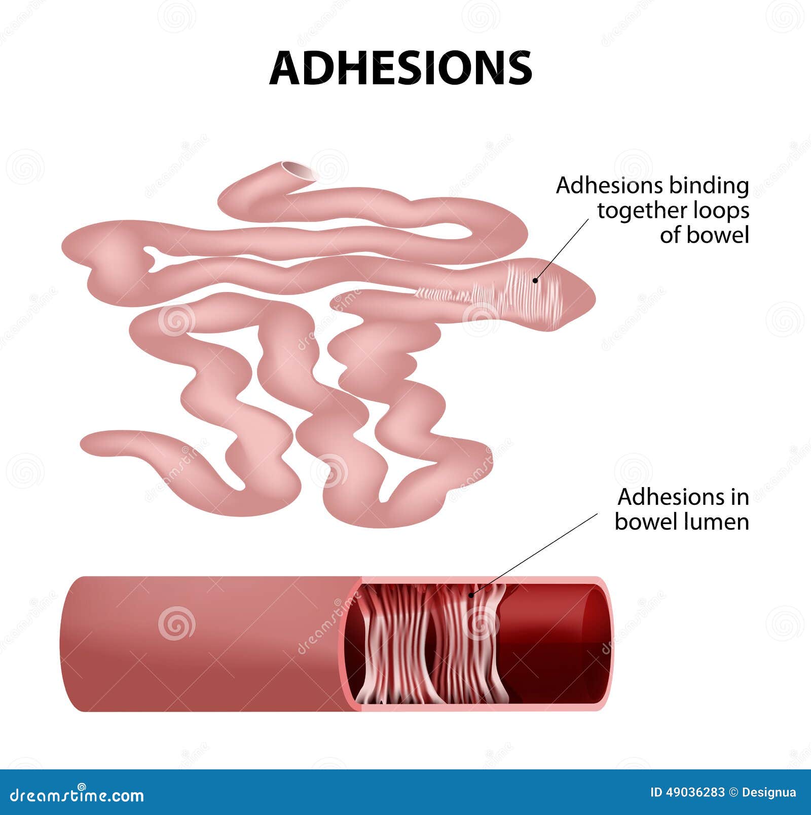 Adhesie vector illustratie. Illustration of kanker, fibroblasten - 49036283