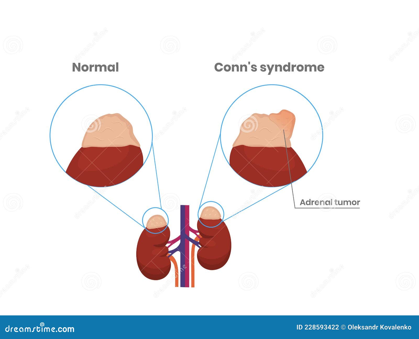 Adrenal Gland Normal Anatomy And Adrenal Adenoma Illustration Stock