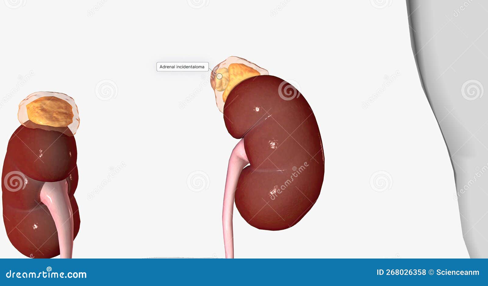 An Adrenal Incidentaloma is a Solid Mass in One or Both Adrenal Glands ...