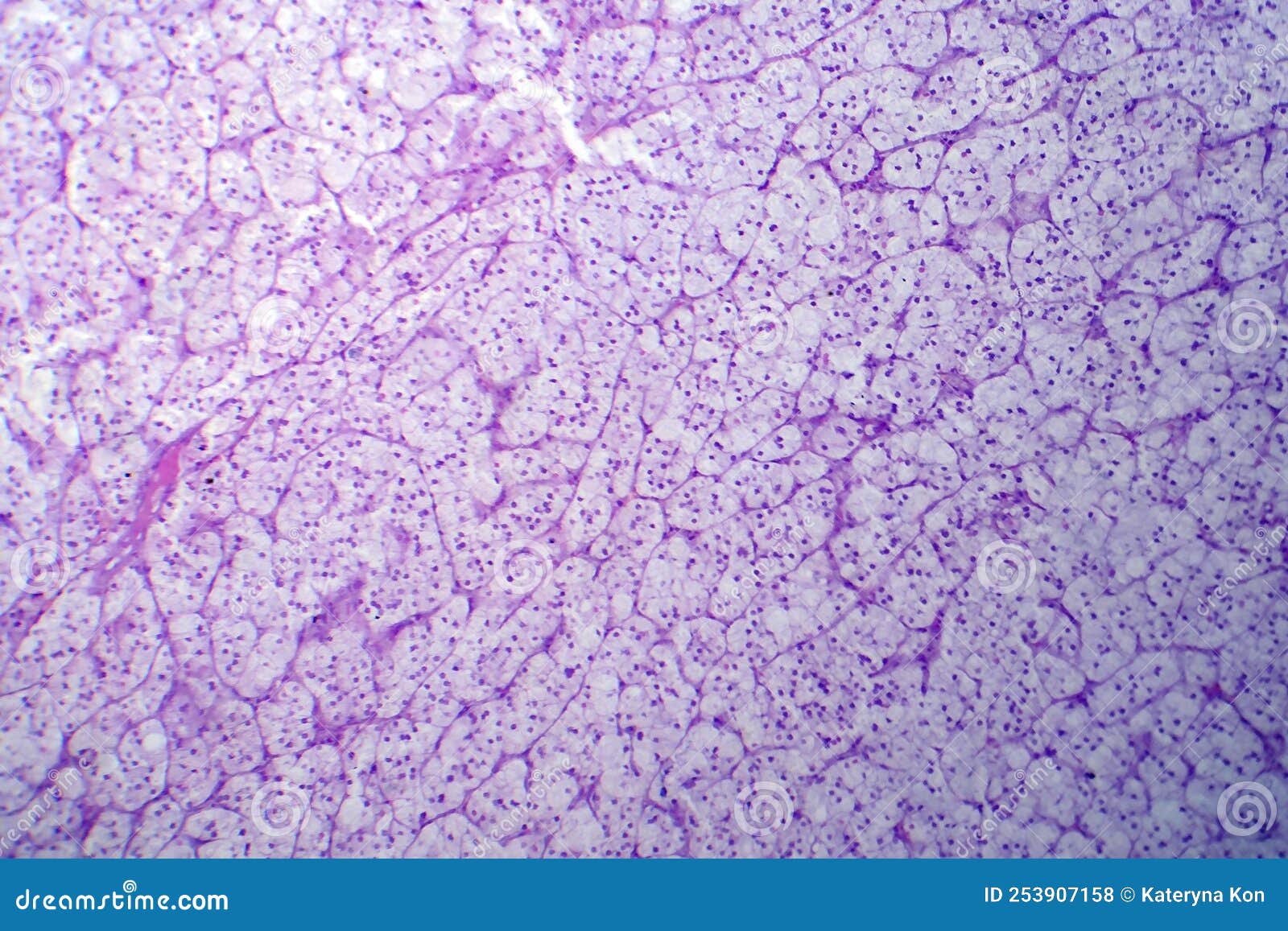 Adrenocortical Adenoma, Light Micrograph Stock Photo - Image of tumour ...