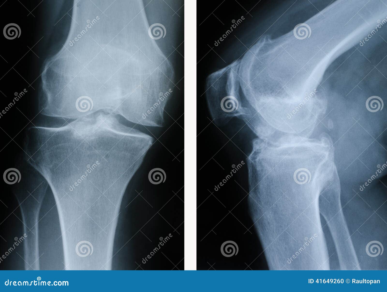 Advanced osteoarthritis stock photo. Image of osteoporosis - 41649260