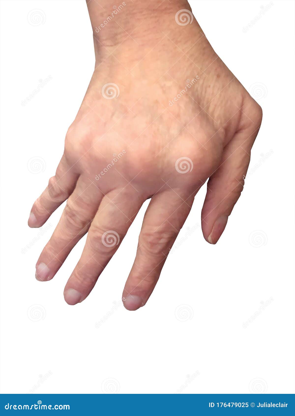 Advanced Rheumatoid Arthritis Effects on Hands Stock Image - Image of ...