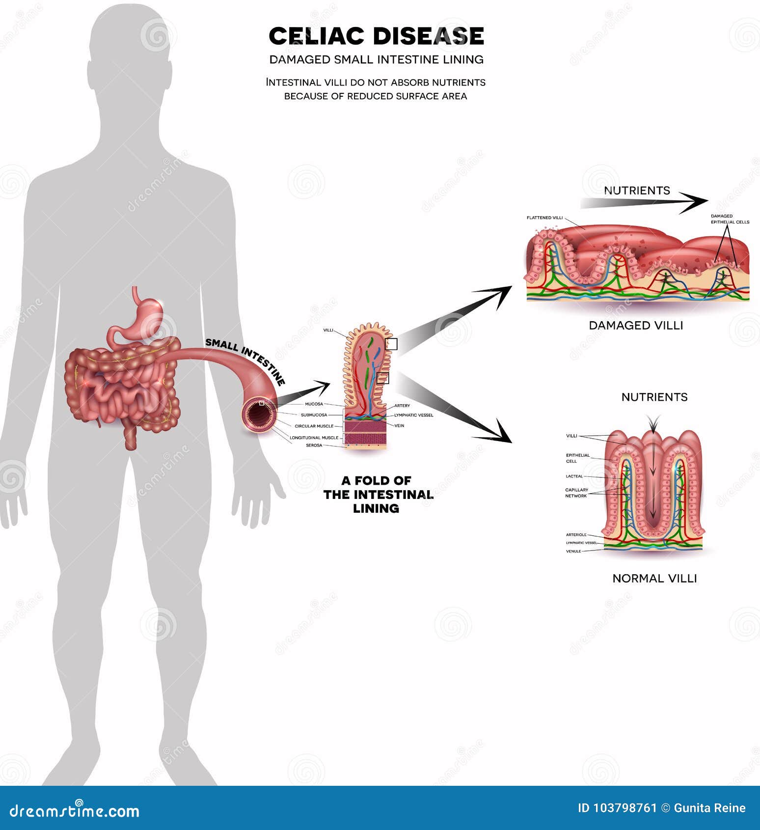 Affiche D'infos De Maladie Coeliaque Illustration de Vecteur ...