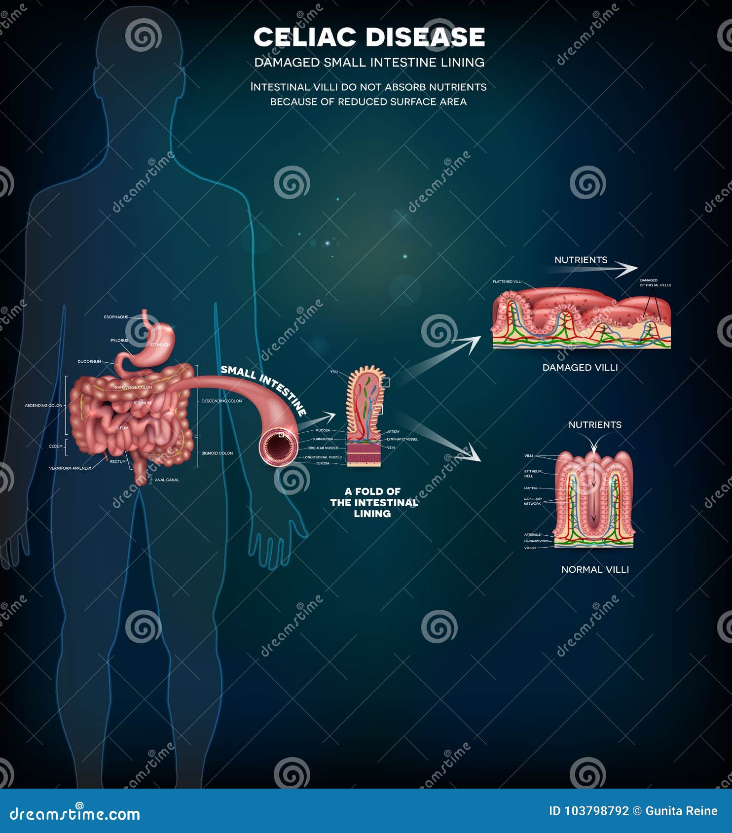 Affiche De Van De Buikholte Van De Ziekteinformatie Vector Illustratie ...