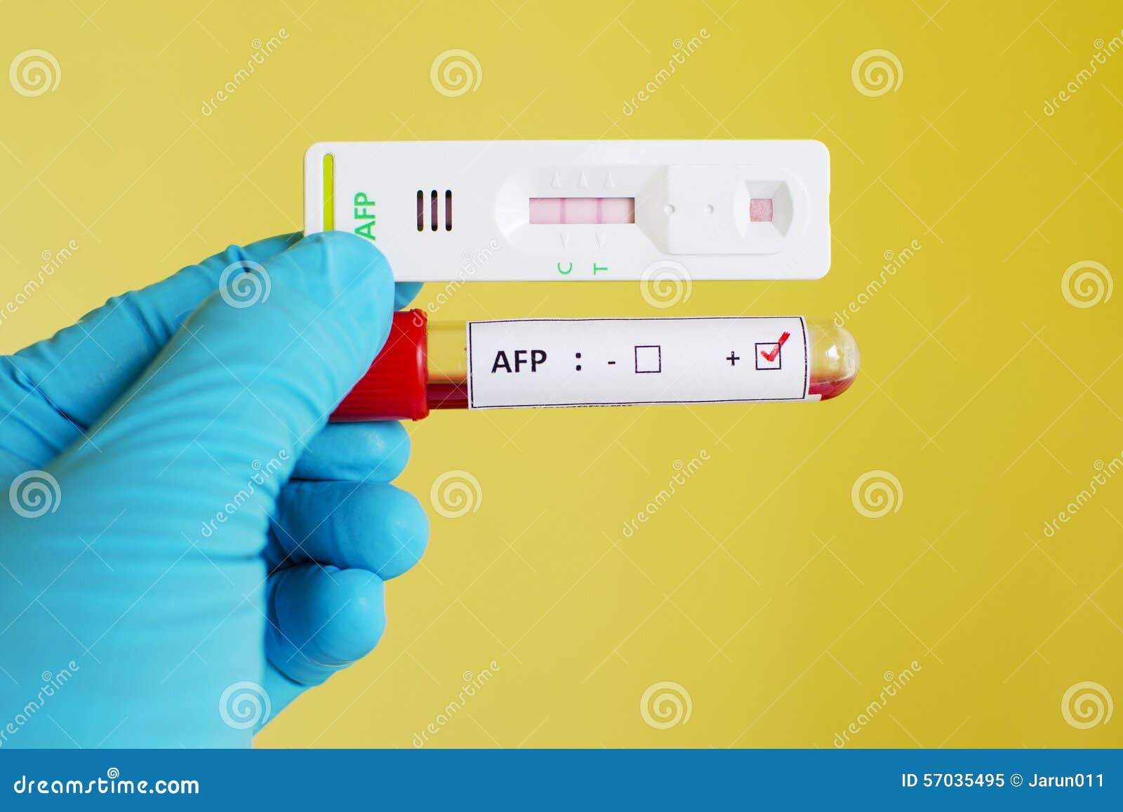 AFP positive stock image. Image of patient, tumor, serology - 57035495