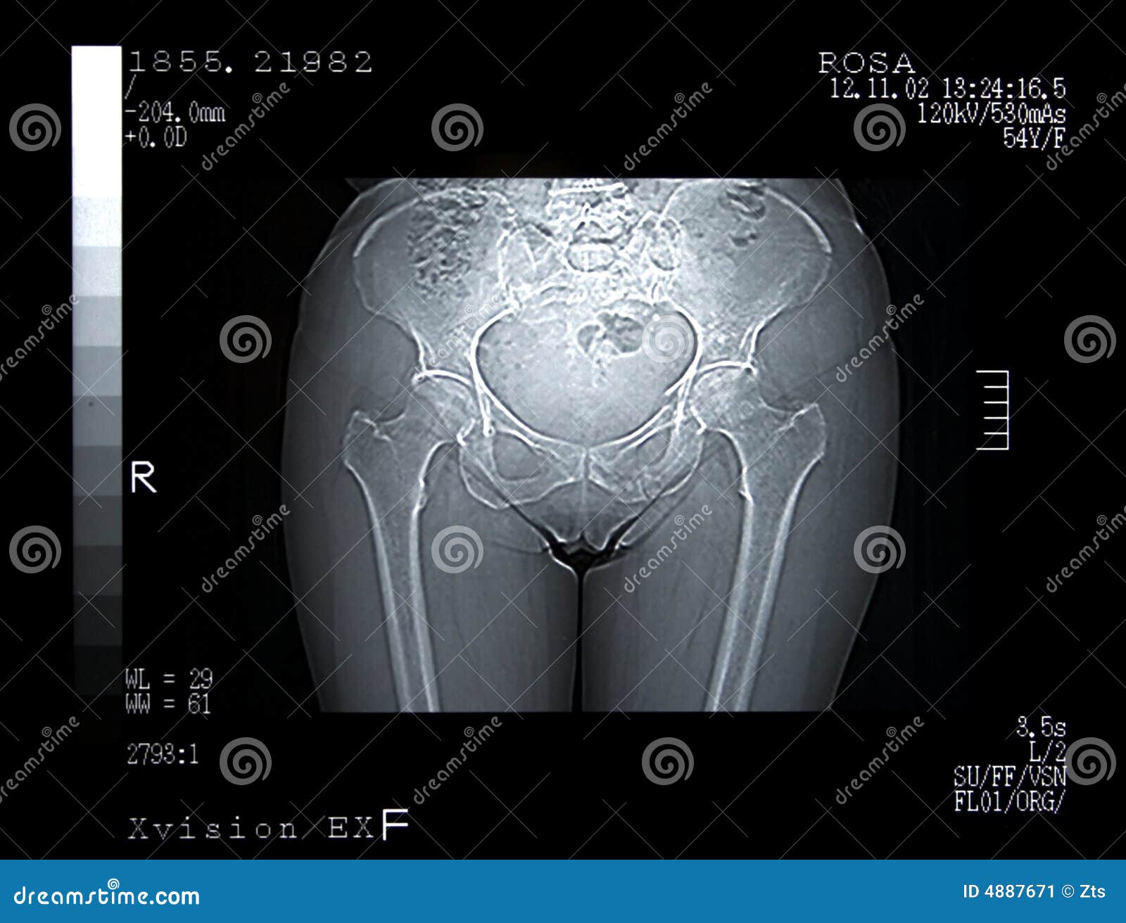 Aftasten Van Een Gebroken Bekken Stock Afbeelding - Image of computer ...