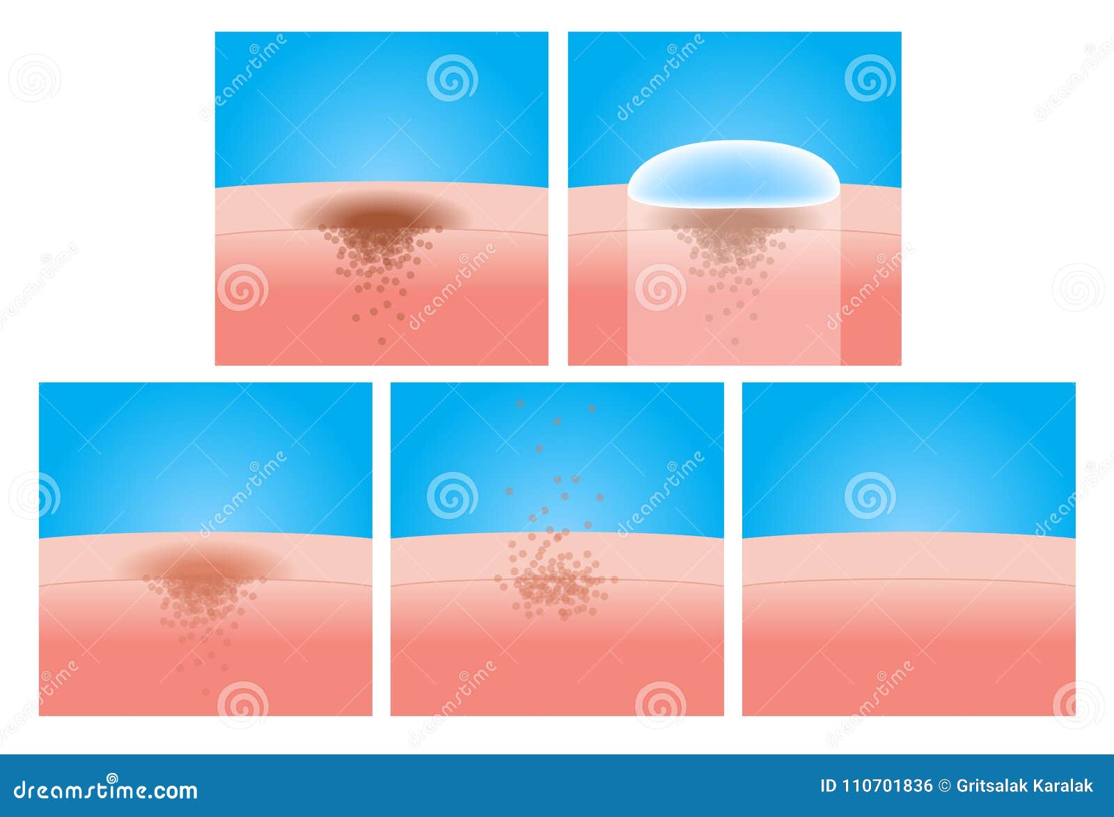 Age Spots of an Elderly Human Vector Stock Vector - Illustration of ...