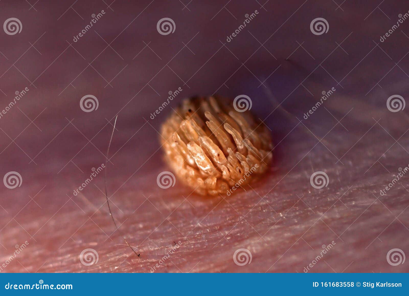 Age Wart on the Underside of Arm Stock Photo - Image of cell, focus ...