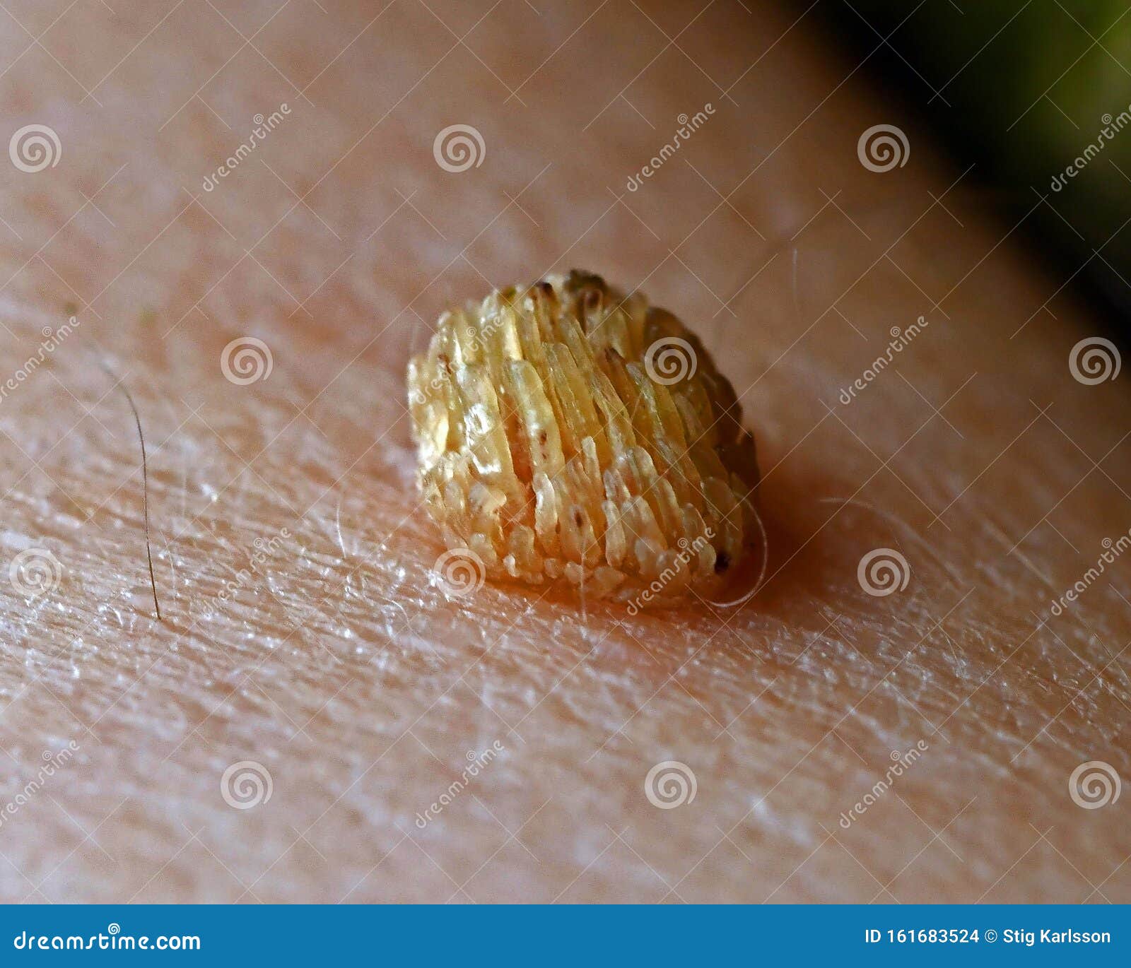 Wart Pictures On Arm at Gladys Zachery blog