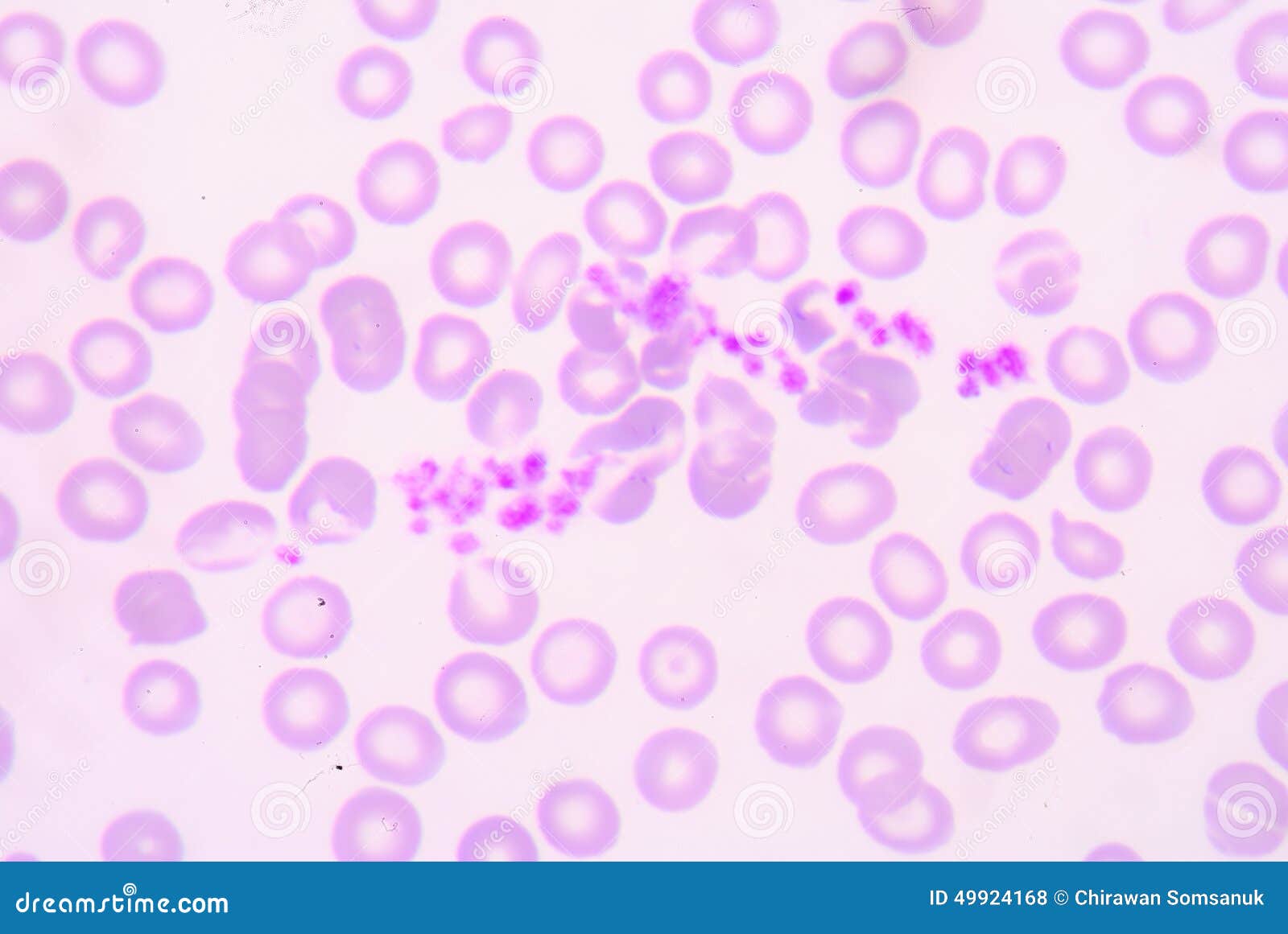 Agglutinamento Della Piastrina Fotografia Stock - Immagine di mazzo ...