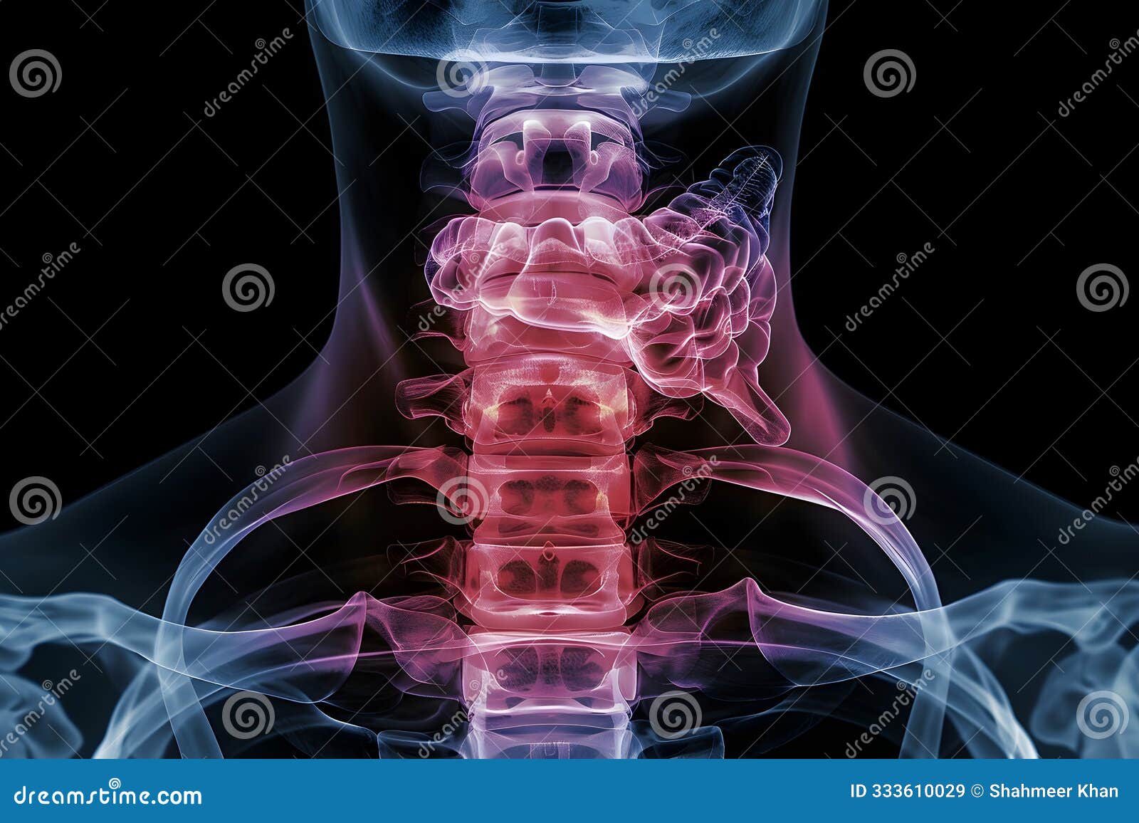In-Depth Radiographic Illustration of Thyroid Gland Disorders Showing ...