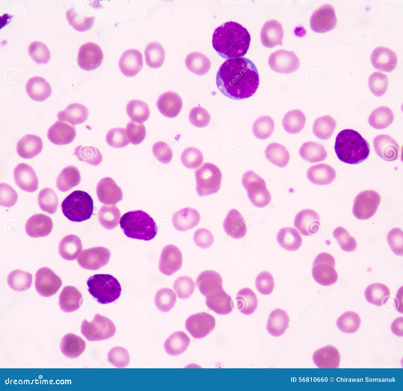 Akut Lymphoblastic Leukemi (ALLA) Arkivfoto - Bild av hälsa, mikroskop ...