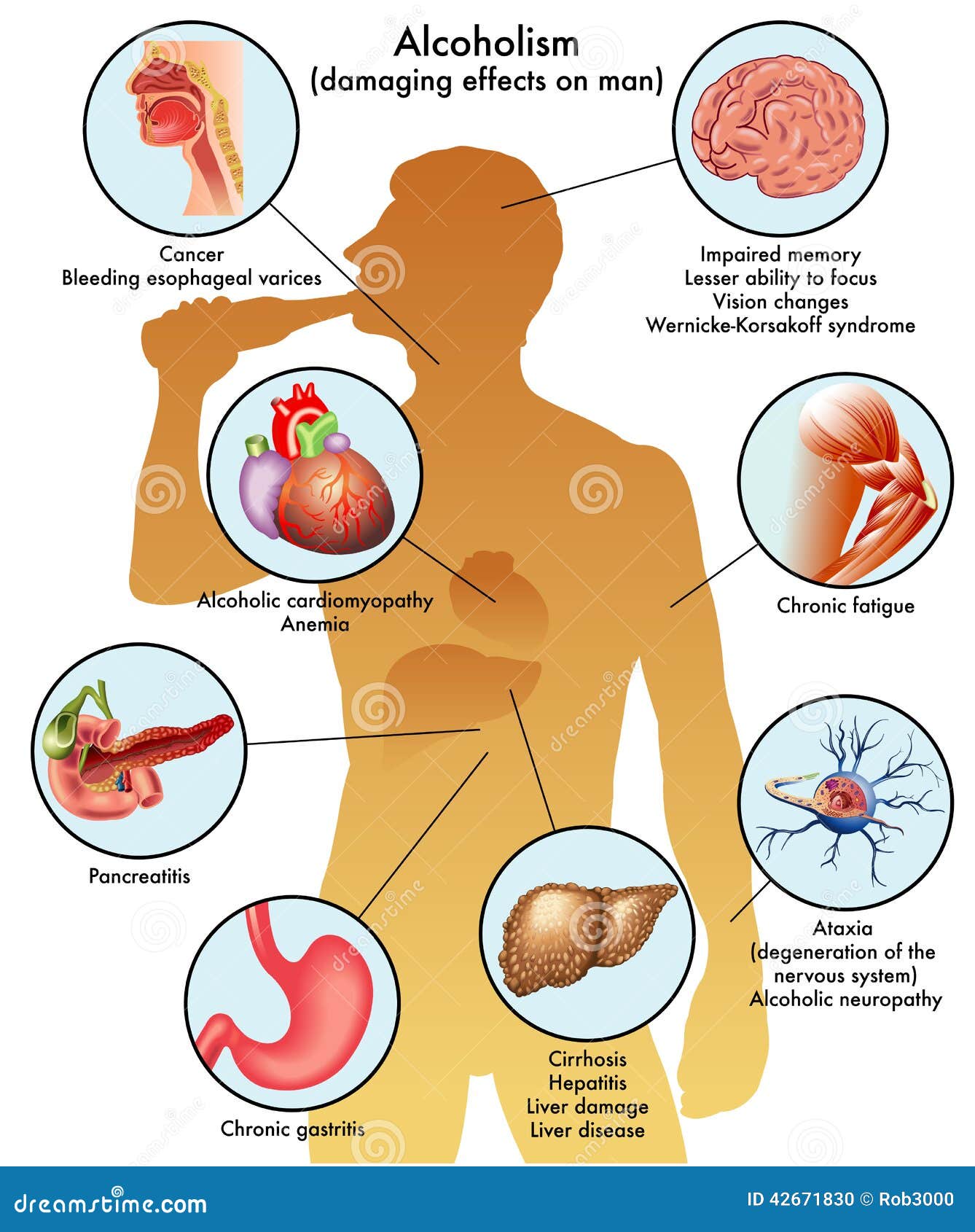 Alcoolisme masculin illustration de vecteur. Illustration du alcoolique ...