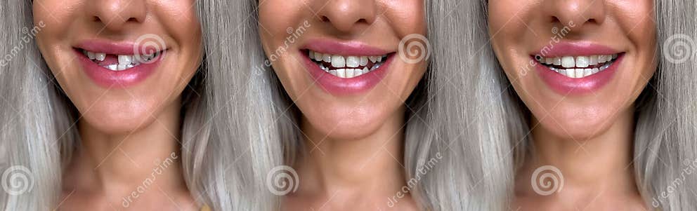 Alignment and Correction of Tooth Defects Stock Photo - Image of girl ...