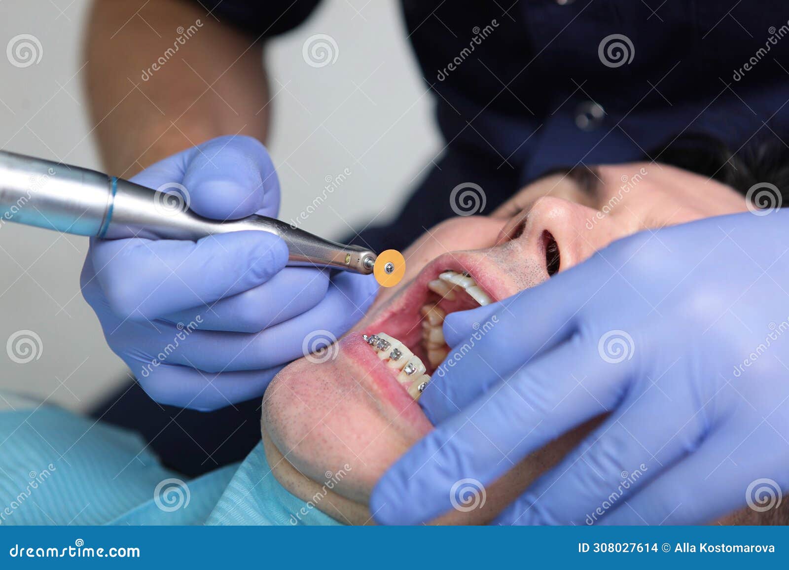 Alignment of the Dentition with Braces. Separation of the Dentition ...