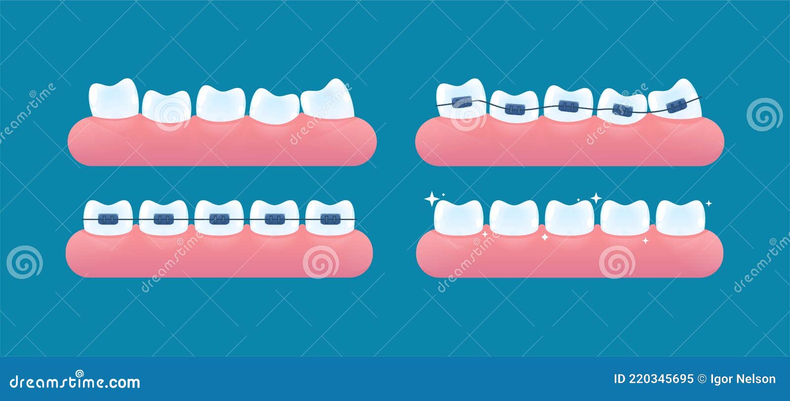 Alignment of Teeth and Bite Correction with the Help of Braces System ...