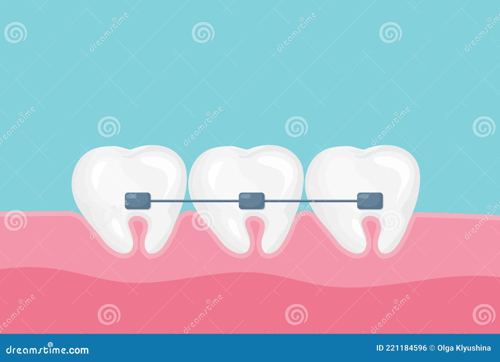 Alignment Of Teeth And Bite Correction With The Help Of Braces System ...