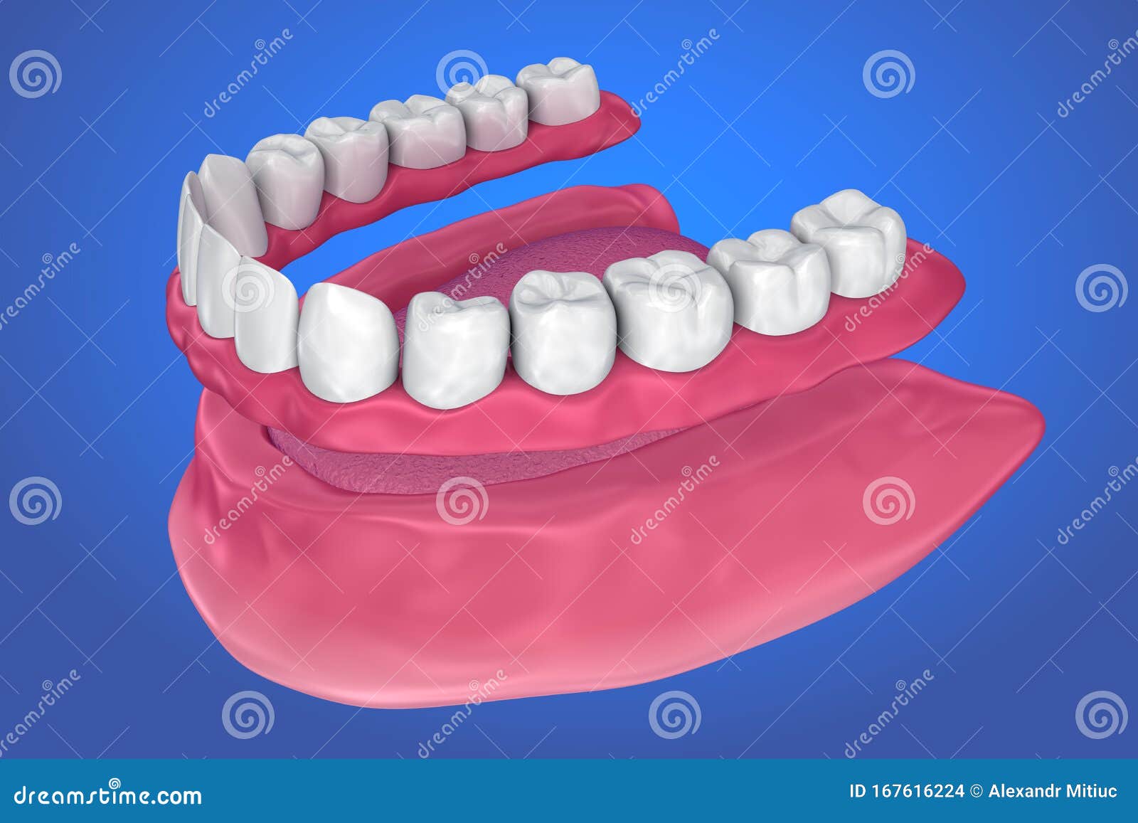 All Missing Teeth - Removable Full Denture Royalty-Free Cartoon ...