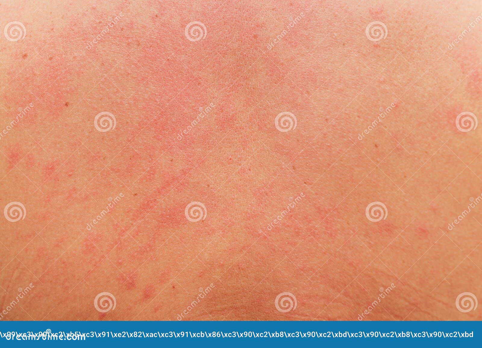 Allergic Rash on the Body of the Patient. Stock Photo - Image of hand ...