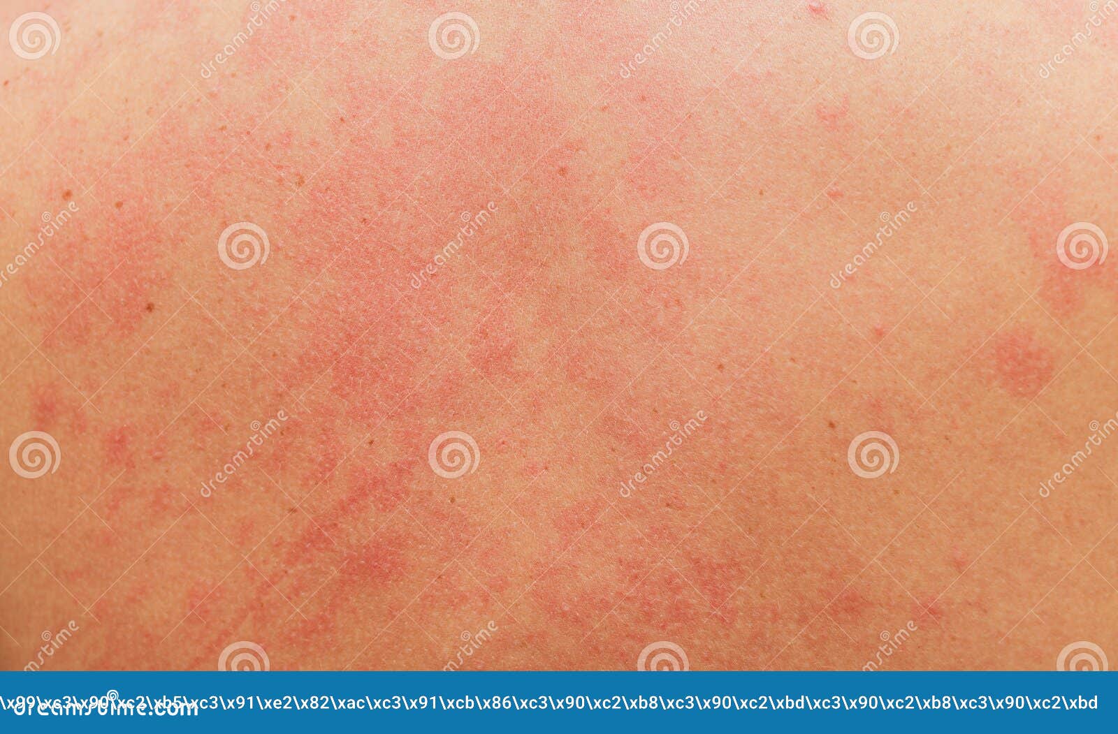Allergic Rash on the Body of the Patient. Stock Image - Image of face ...