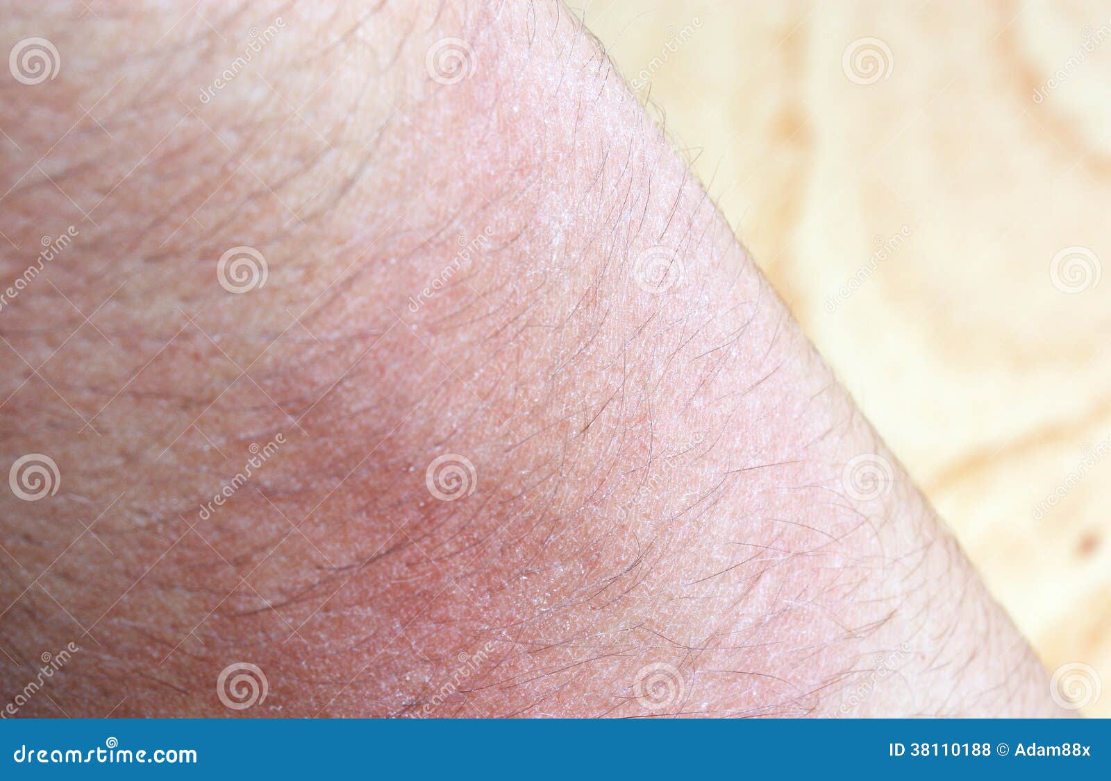 Allergic Rash Dermatitis Eczema Skin On Leg Of Patient Psoriasis And Eczema Skin With Big Red