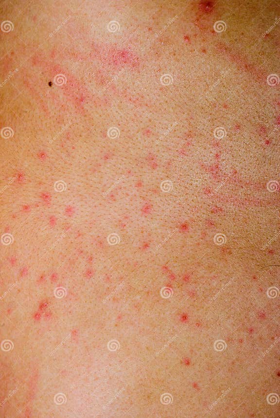 Allergic Rash Dermatitis Skin Stock Image - Image of dermatitis ...