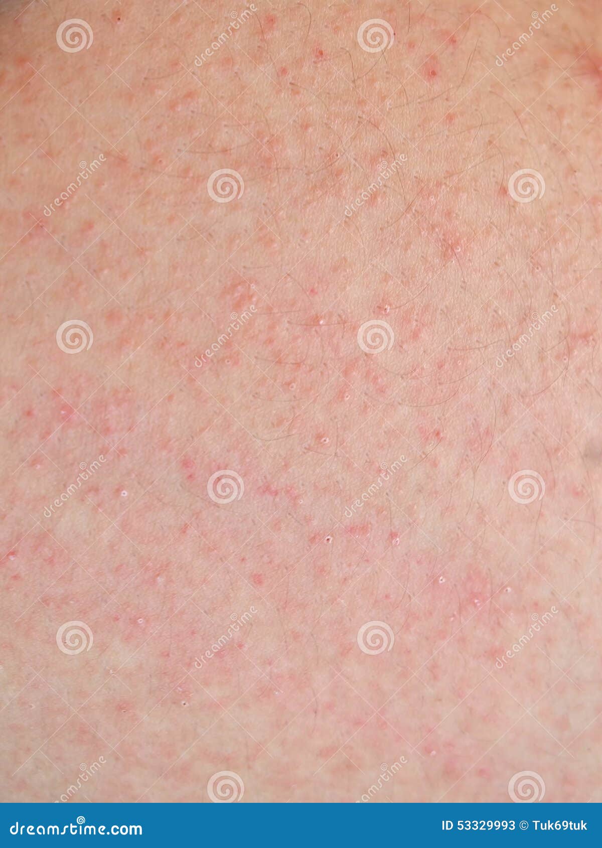 Allergic Rash Dermatitis Skin Stock Image - Image of medicine, medical ...