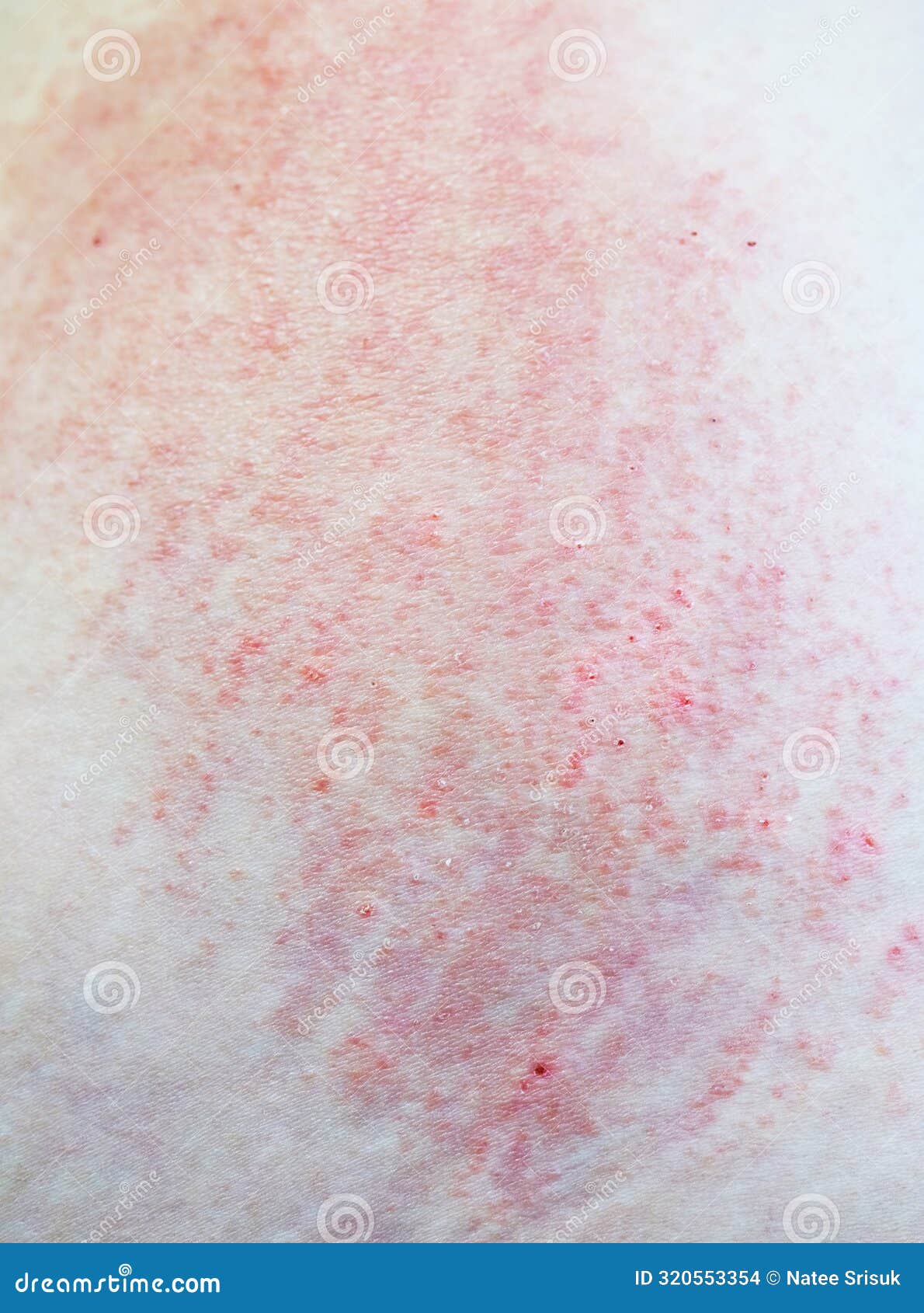 Allergic Rash Dermatitis Eczema Skin On Leg Of Patient Psoriasis And Eczema Skin With Big Red