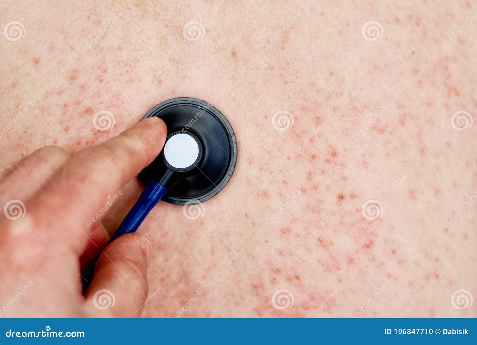 Allergic Rash on Skin. Woman with Dermatology Problem on Back Skin ...