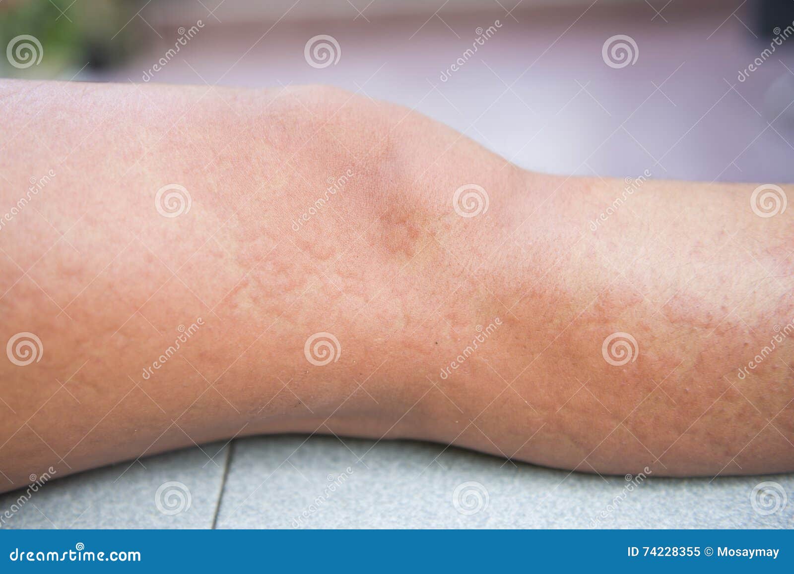 Allergic Reactions Caused by Urticaria Stock Image - Image of body ...