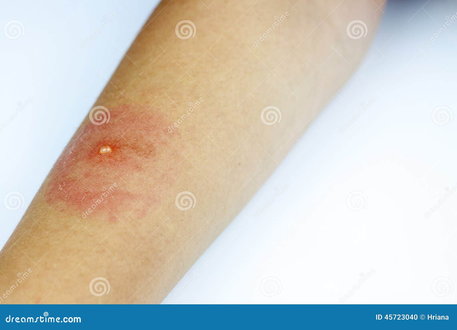 Allergic Reactions To Insect Stings Stock Photo - Image of body ...