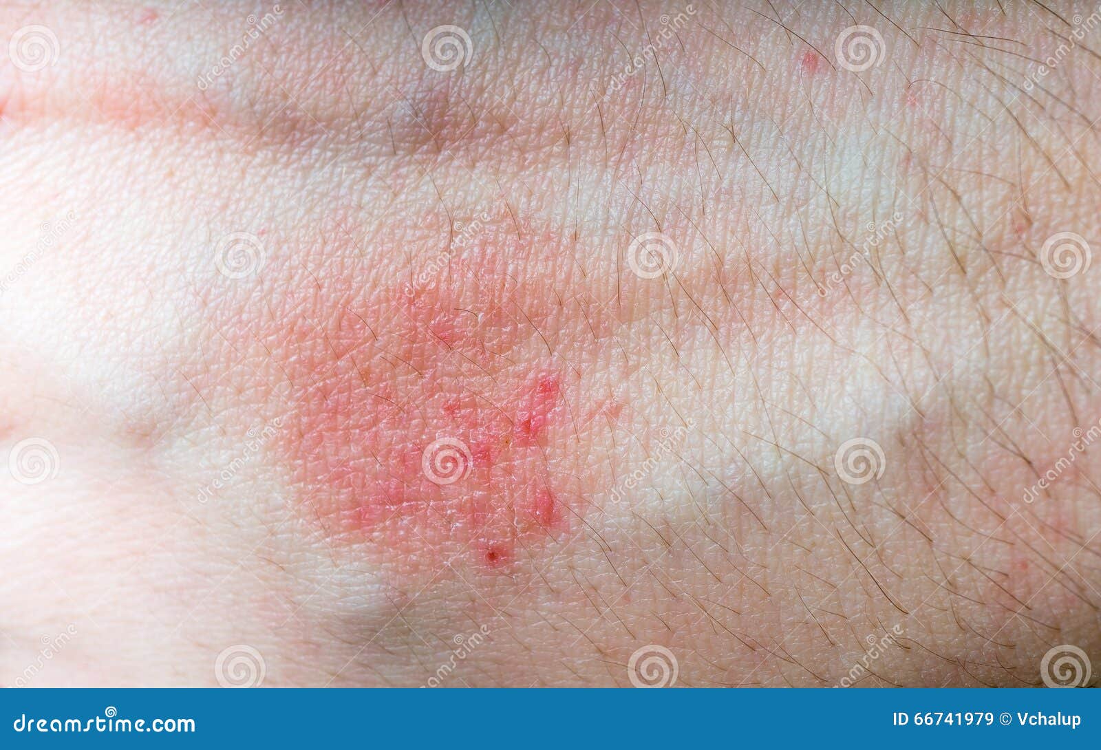 Allergic Rush or Aczema on Skin Stock Image - Image of rush, malady ...