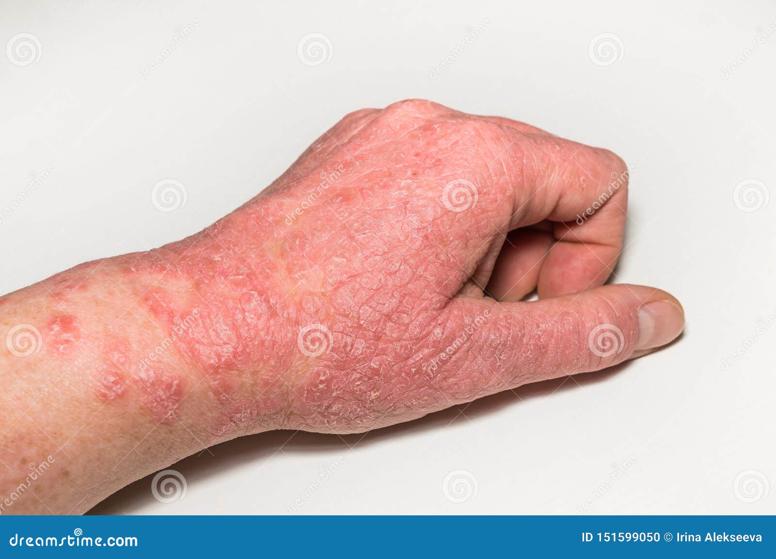 Allergic Skin Lesions Of The Hand With Cracks Inflammation And Flaking