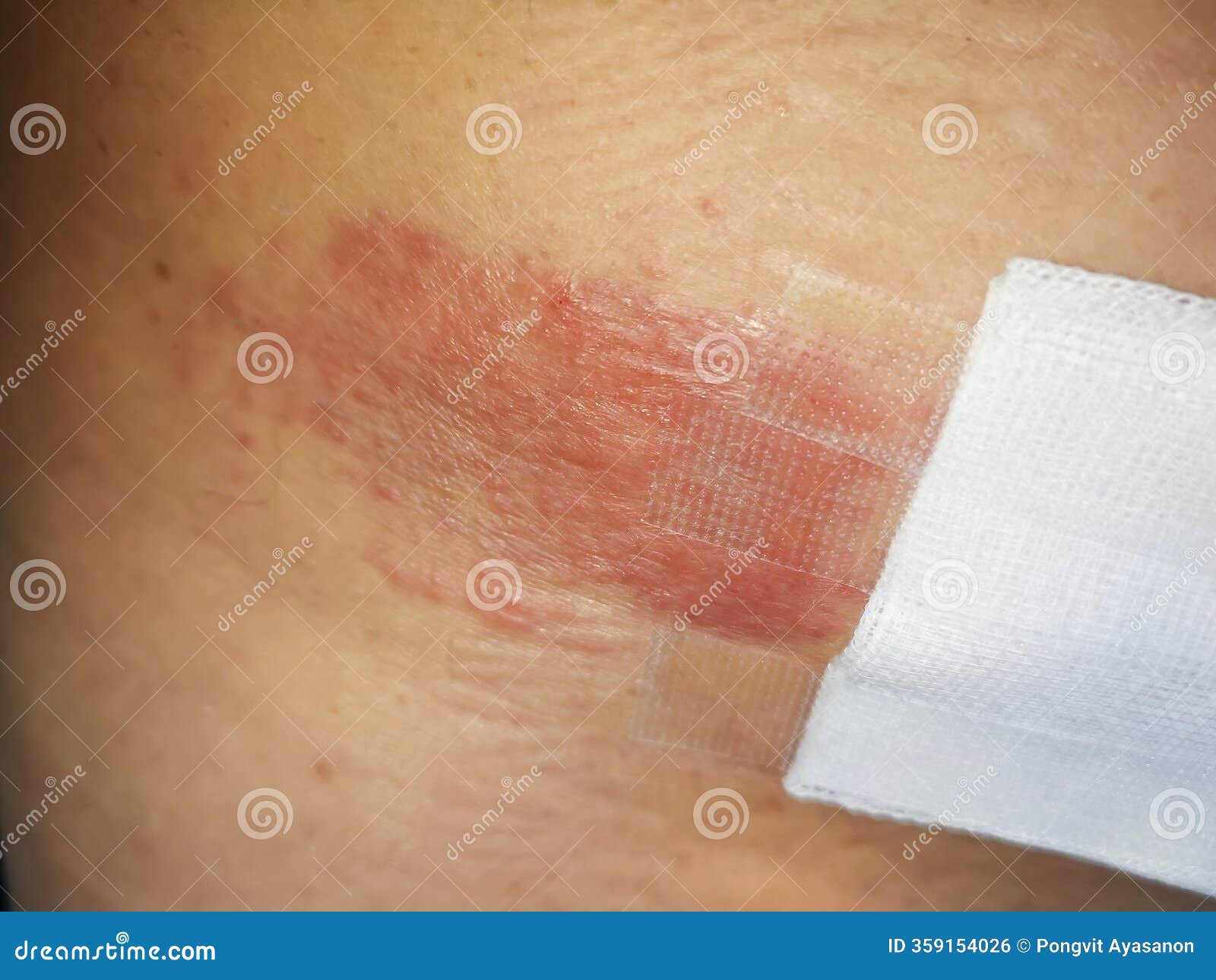 Allergic Skin Lesions On The Arms Thailand Asian Women. Royalty-Free ...